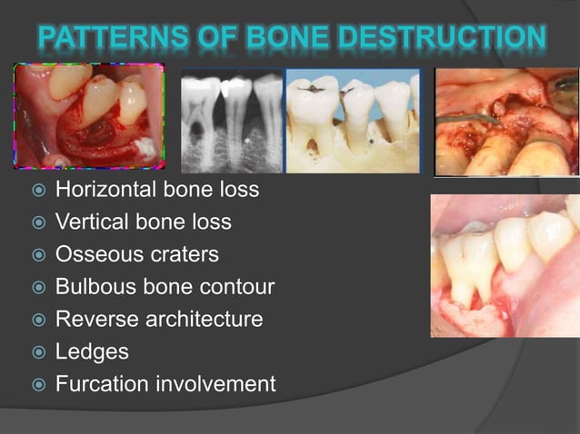Bone loss and patterns of bone destruction | PPTX | Bone and Joint ...
