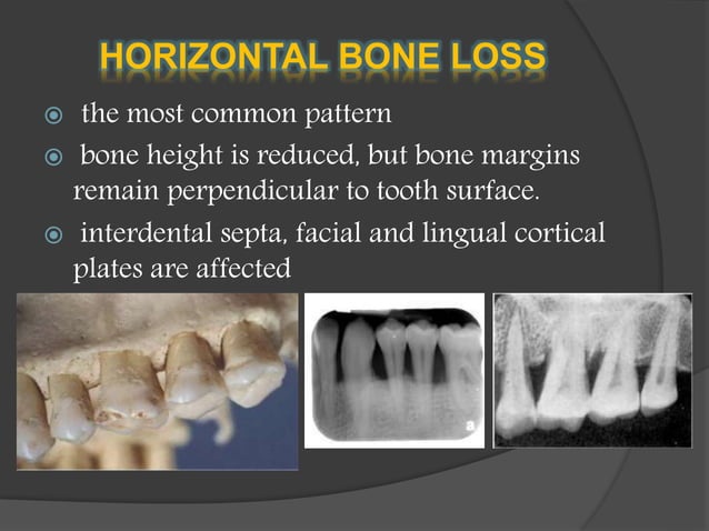 Bone loss and patterns of bone destruction | PPTX | Bone and Joint ...