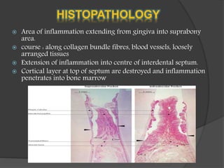 Bone loss and patterns of bone destruction | PPTX