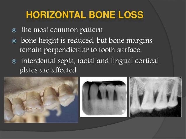 Bone loss and patterns of bone destruction