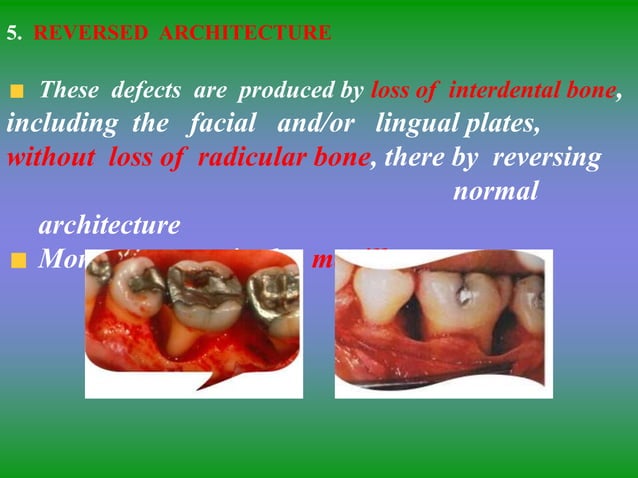 BONE LOSS AND PATTERNS OF BONE DESTRUCTION.ppt