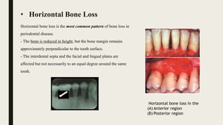 BONE LOSS AND PATTERNS OF BONE DESTRUCTION.pptx