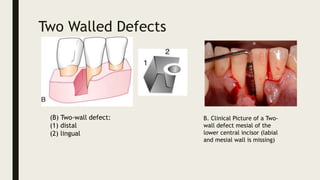 BONE LOSS AND PATTERNS OF BONE DESTRUCTION.pptx
