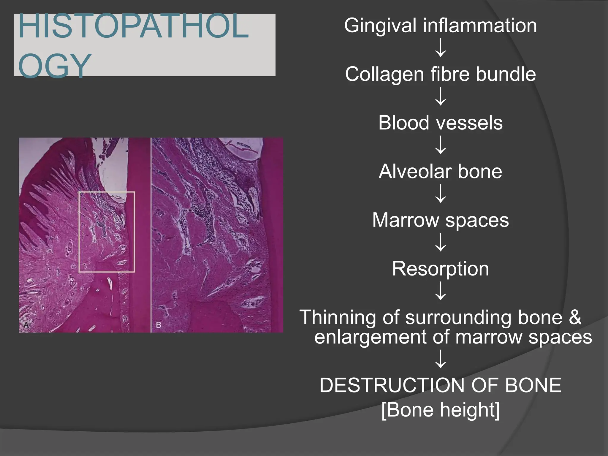 BONE LOSS AND PATTERNS OF BONE DESTRUCTION.pptx