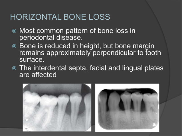 BONE LOSS AND PATTERNS OF BONE DESTRUCTION.pptx