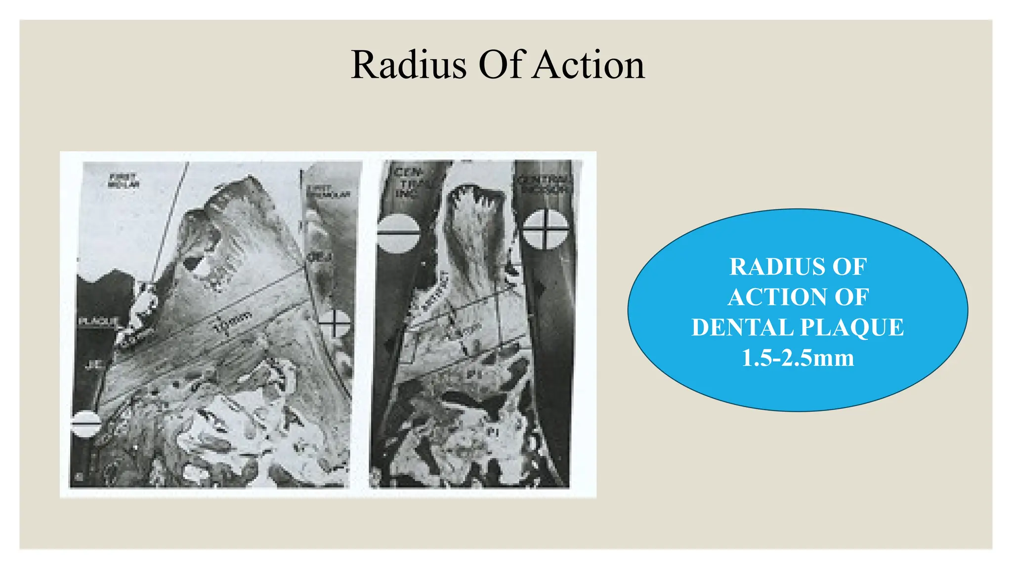 BONE LOSS AND PATTERNS OF BONE DESTRUCTION.pptx