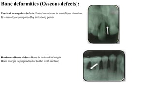 BONE LOSS AND PATTERNS OF BONE DESTRUCTION ishu.pptx