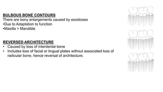 BONE LOSS AND PATTERNS OF BONE DESTRUCTION ishu.pptx
