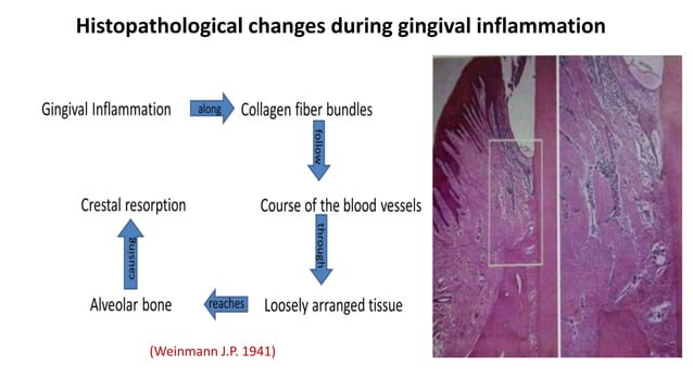 BONE LOSS AND PATTERNS OF BONE DESTRUCTION ishu.pptx