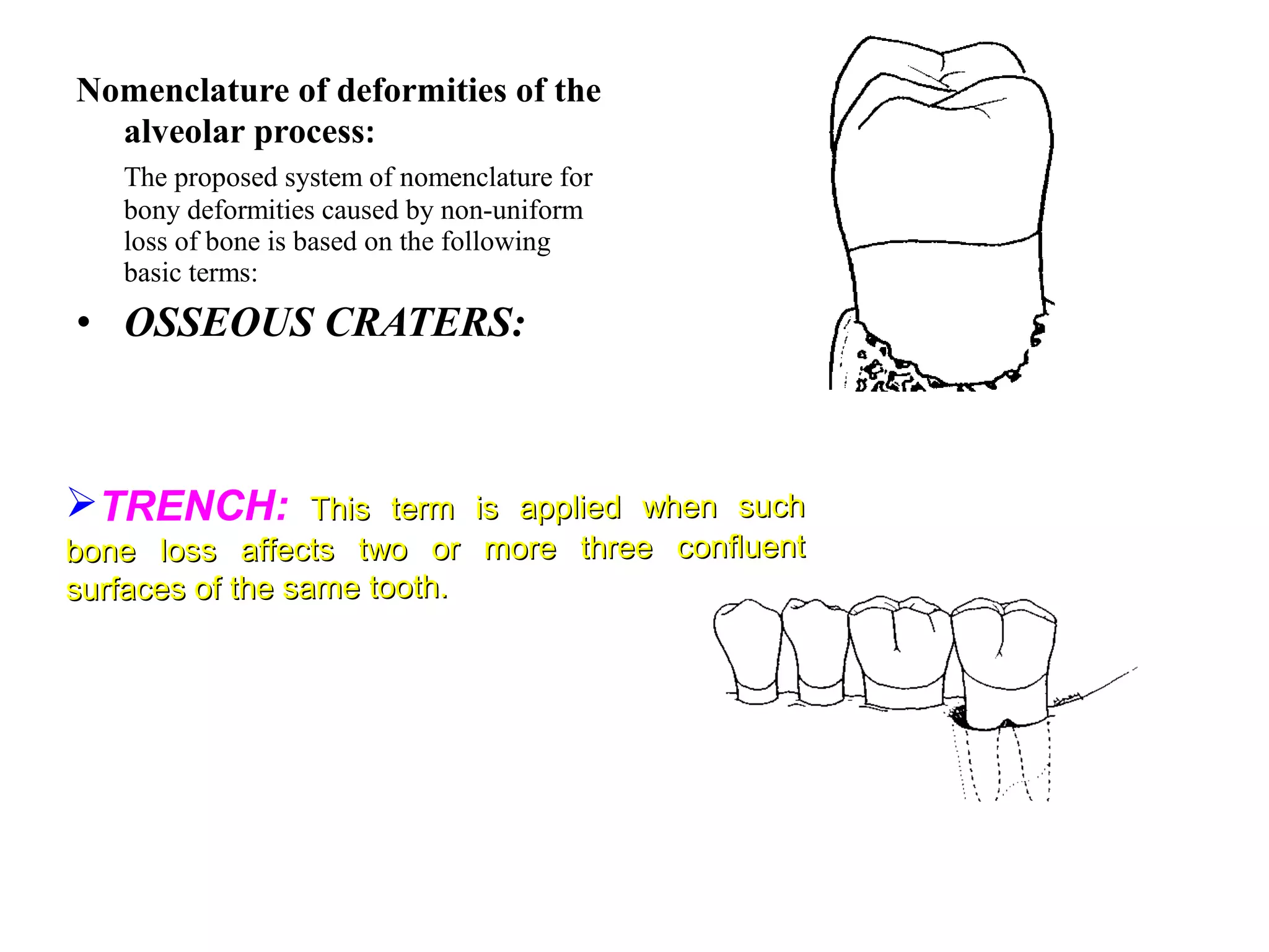 Bone loss and patterns of bone loss | PPT
