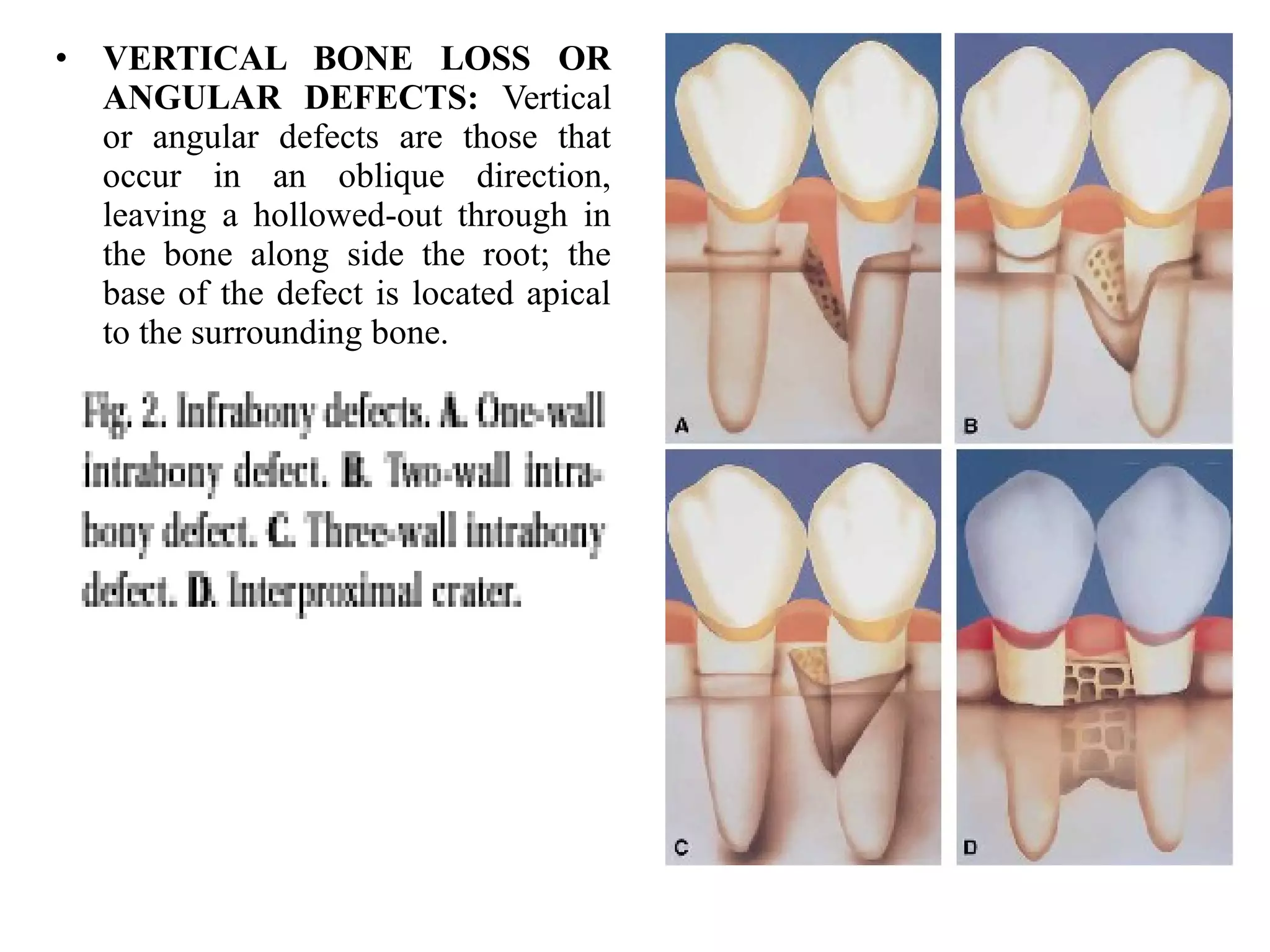 Bone loss and patterns of bone loss | PPT