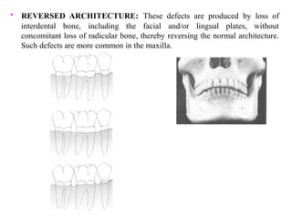 Bone loss and patterns of bone loss | PPT