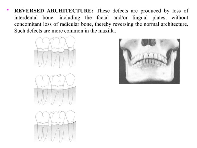 Bone loss and patterns of bone loss | PPT