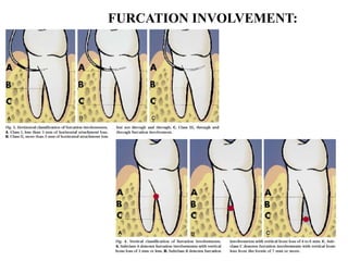 Bone loss and patterns of bone loss | PPT
