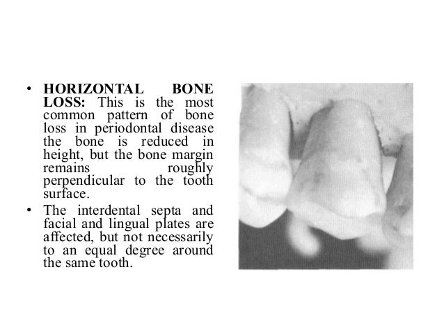 Bone loss and patterns of bone loss