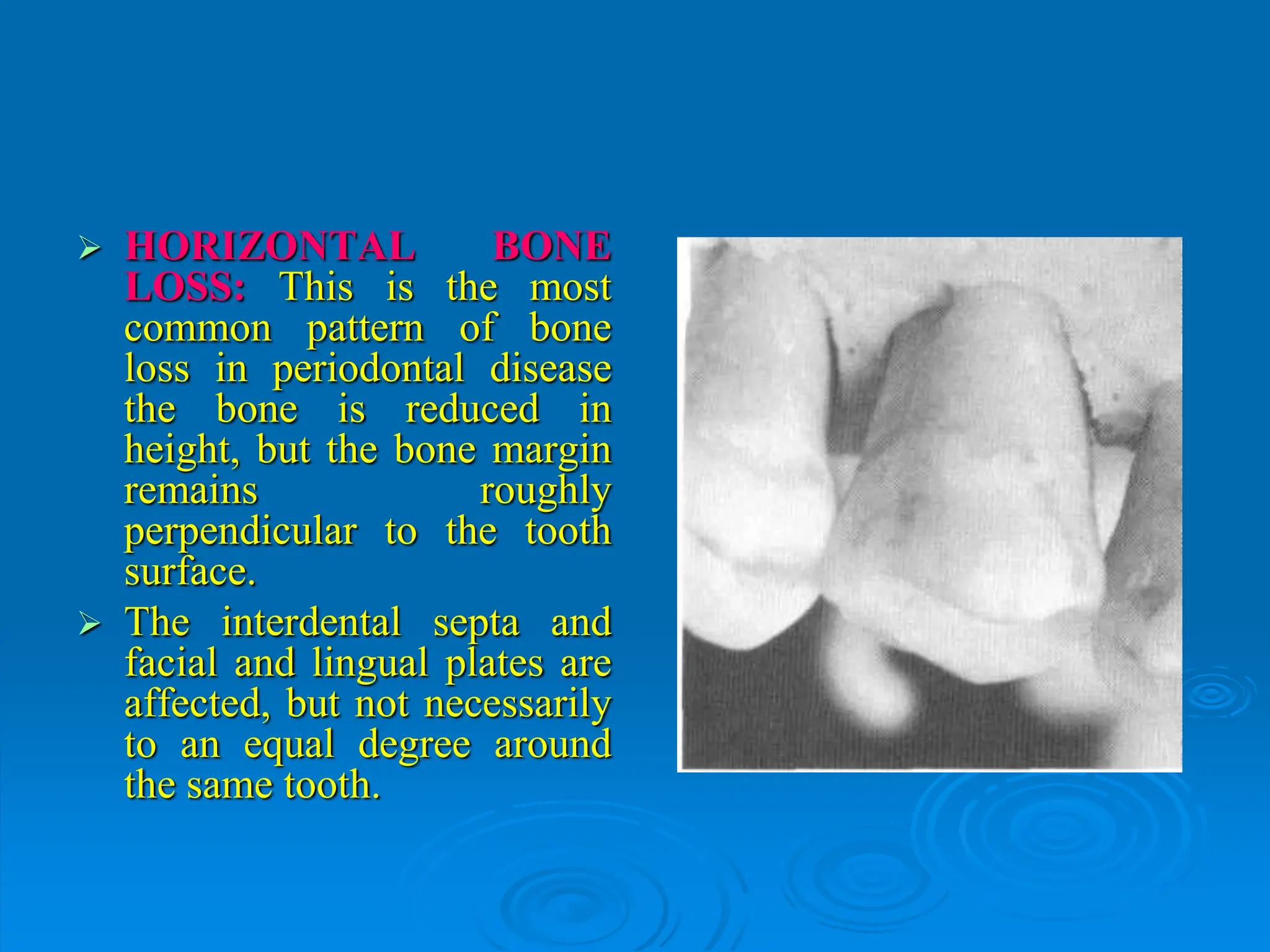 bone loss and patterns of bone loss.ppt1