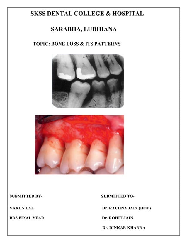 Bone loss patterns | PDF | Bone and Joint Conditions | Diseases and ...