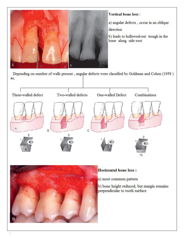 Bone loss patterns | PDF | Bone and Joint Conditions | Diseases and ...