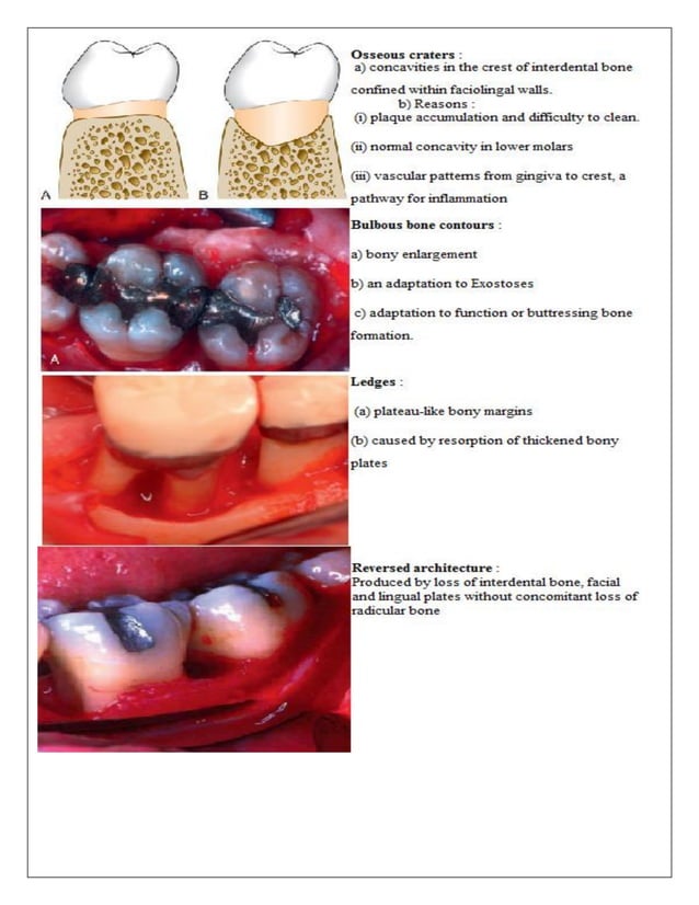 Bone loss patterns | PDF | Bone and Joint Conditions | Diseases and ...