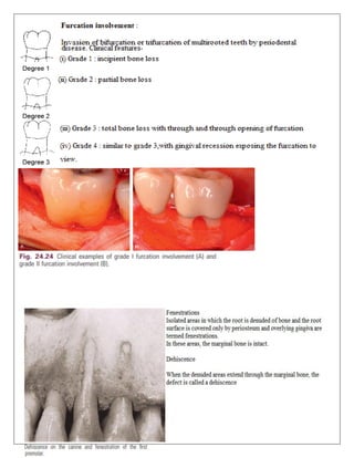Bone loss patterns | PDF