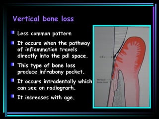 Bone loss | PPT
