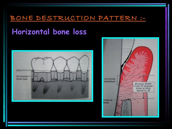 Bone Loss