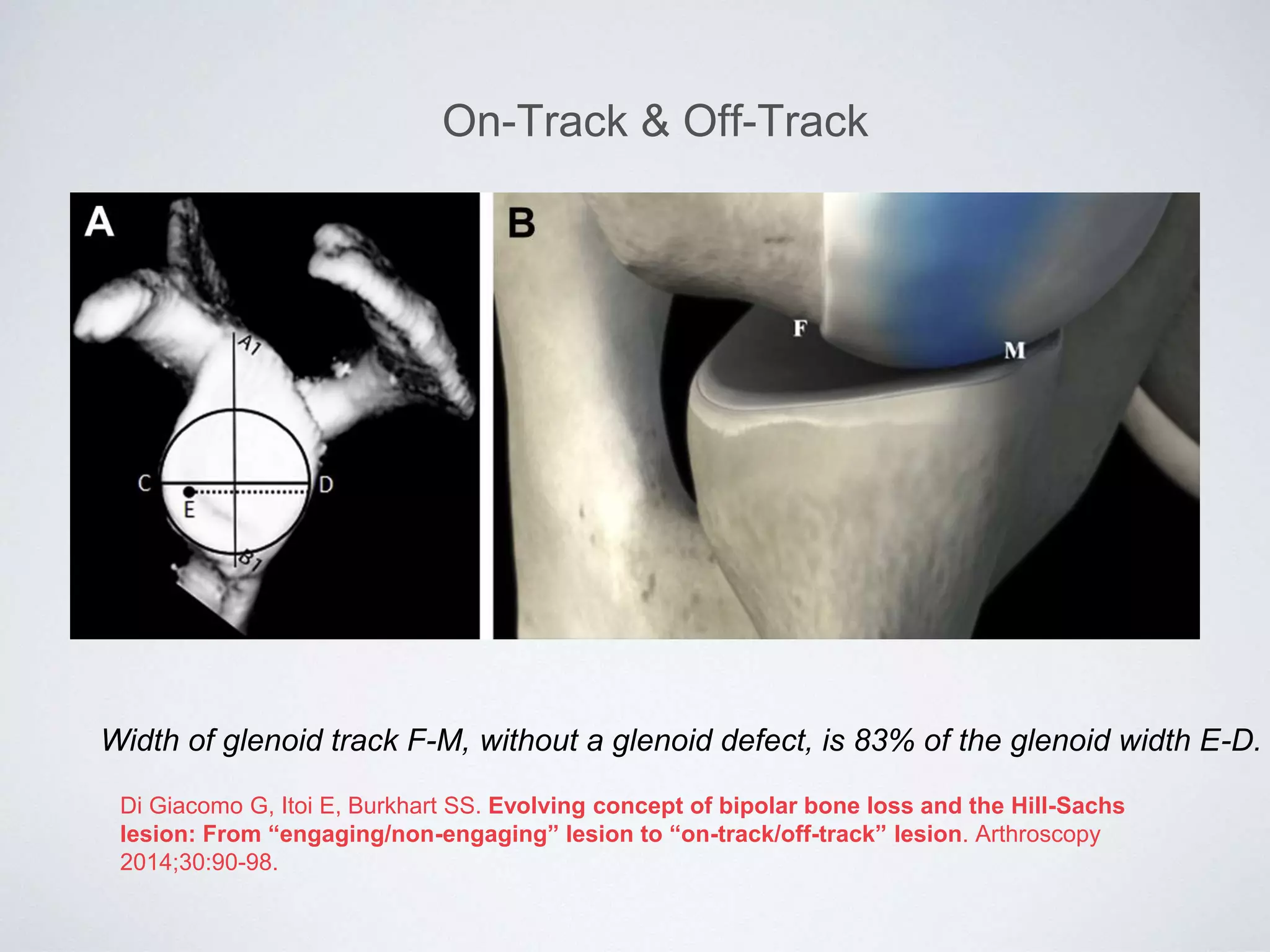 Recurrent Anterior instability of Shoulder with bone loss | PPT