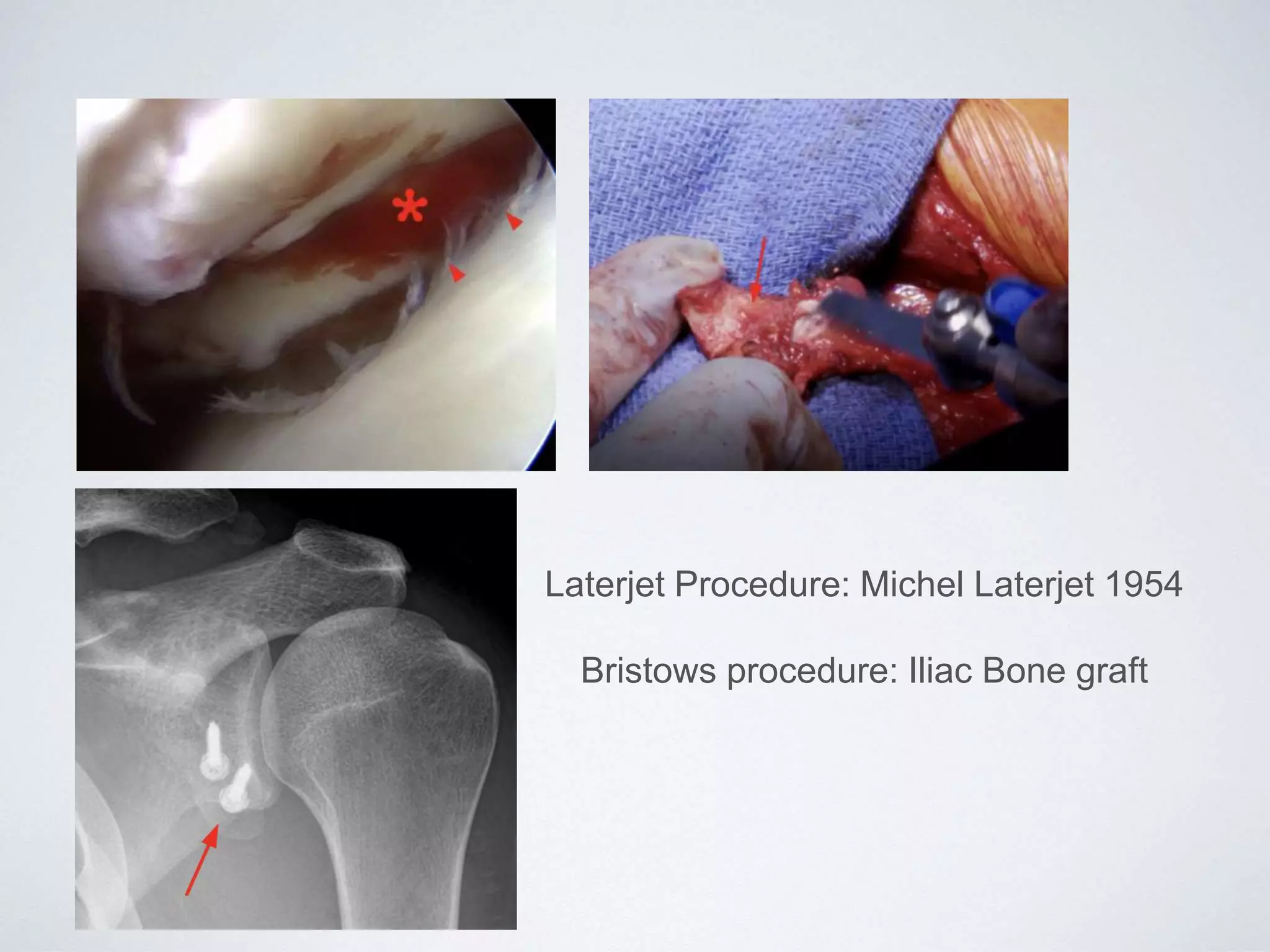 Recurrent Anterior instability of Shoulder with bone loss | PPT