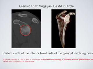 Recurrent Anterior instability of Shoulder with bone loss | PPT