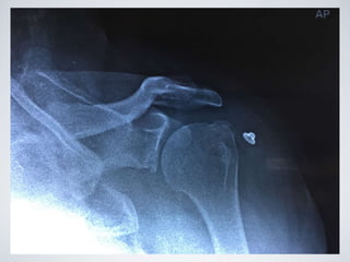Recurrent Anterior instability of Shoulder with bone loss | PPTX