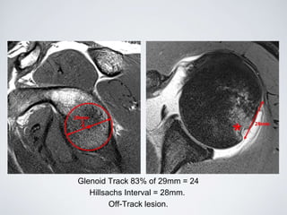 Recurrent Anterior instability of Shoulder with bone loss | PPTX