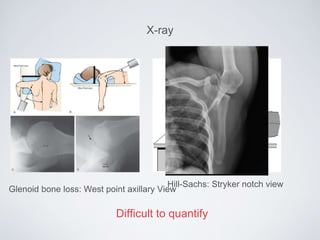 Recurrent Anterior instability of Shoulder with bone loss | PPT
