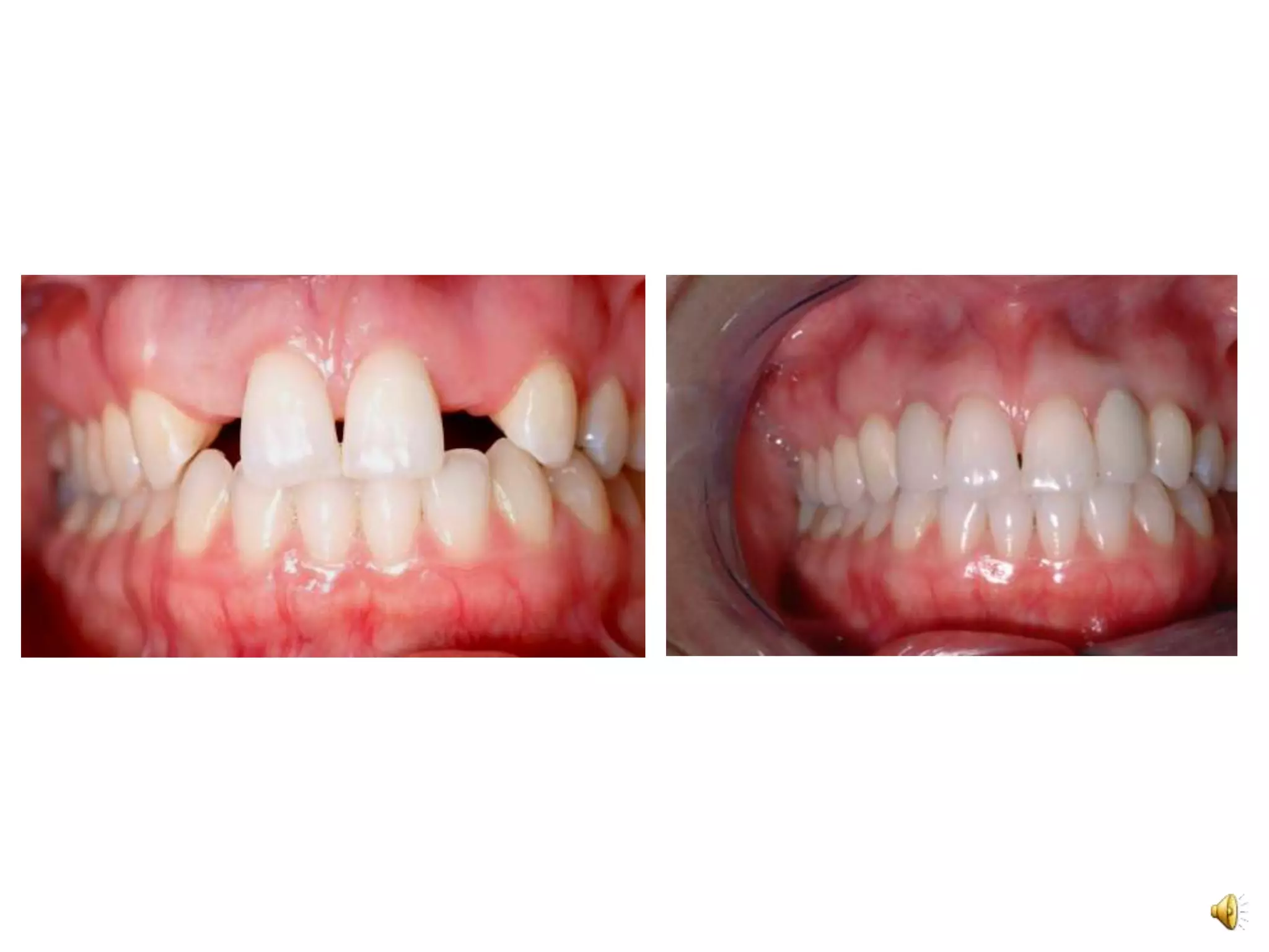 Bone manipulation with smile design #6 | PPTX