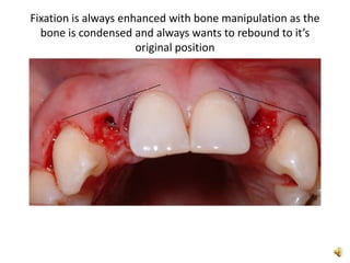 Bone manipulation with smile design #6 | PPTX | Dental Health ...
