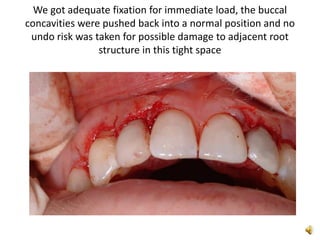 Bone manipulation with smile design #6 | PPTX | Dental Health ...