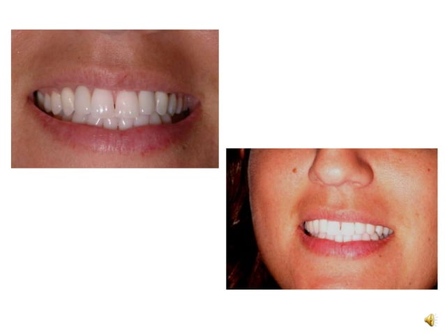 Bone manipulation with smile design #6 | PPTX | Dental Health ...