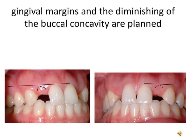 Bone manipulation with smile design #6 | PPTX | Dental Health ...