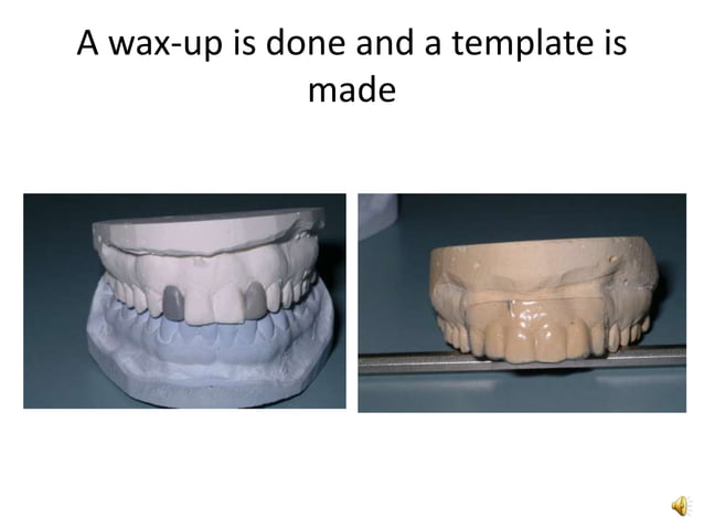 Bone manipulation with smile design #6 | PPTX | Dental Health ...