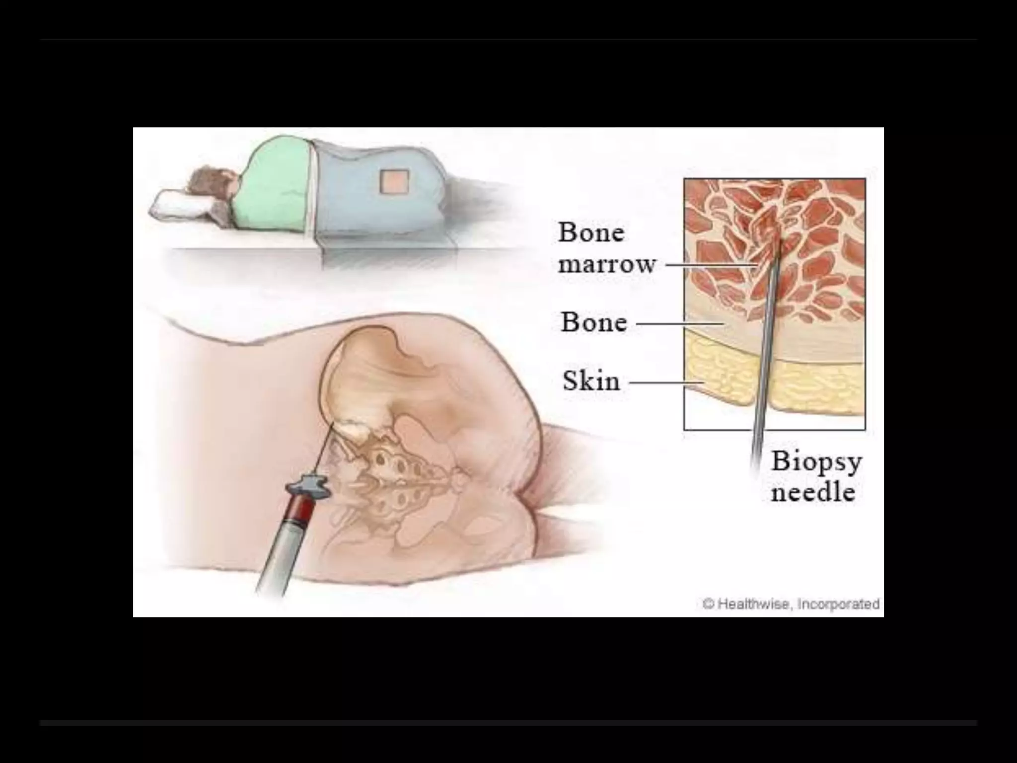 Bone marrow biopsy and interpretation | PPTX