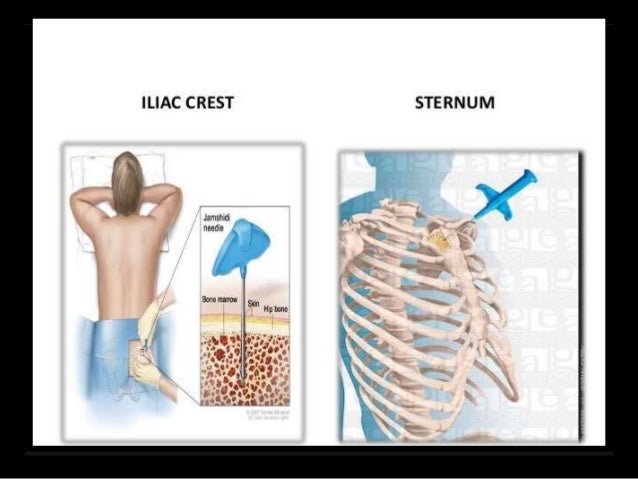 Bone marrow biopsy and interpretation