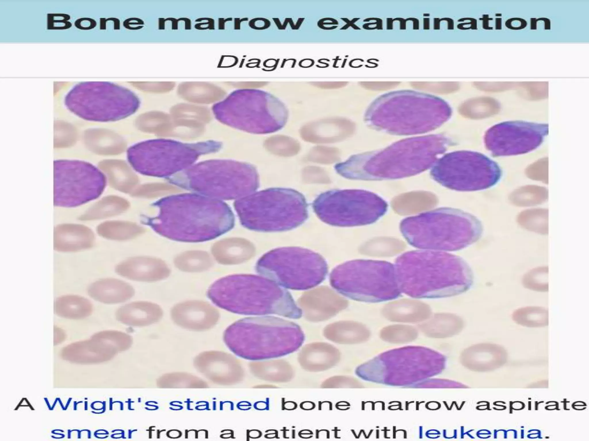 Bone marrow aspirate&biopsy preparation | PPTX