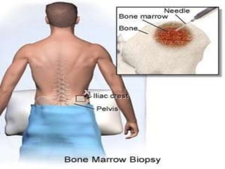 Bone marrow aspirate&biopsy preparation | PPTX
