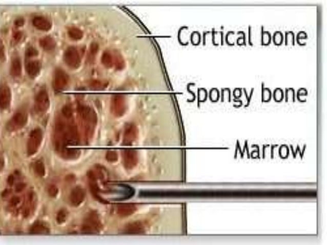 Bone marrow aspirate&biopsy preparation | PPTX