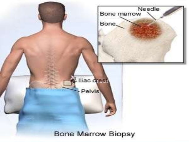 Bone marrow aspirate&biopsy preparation