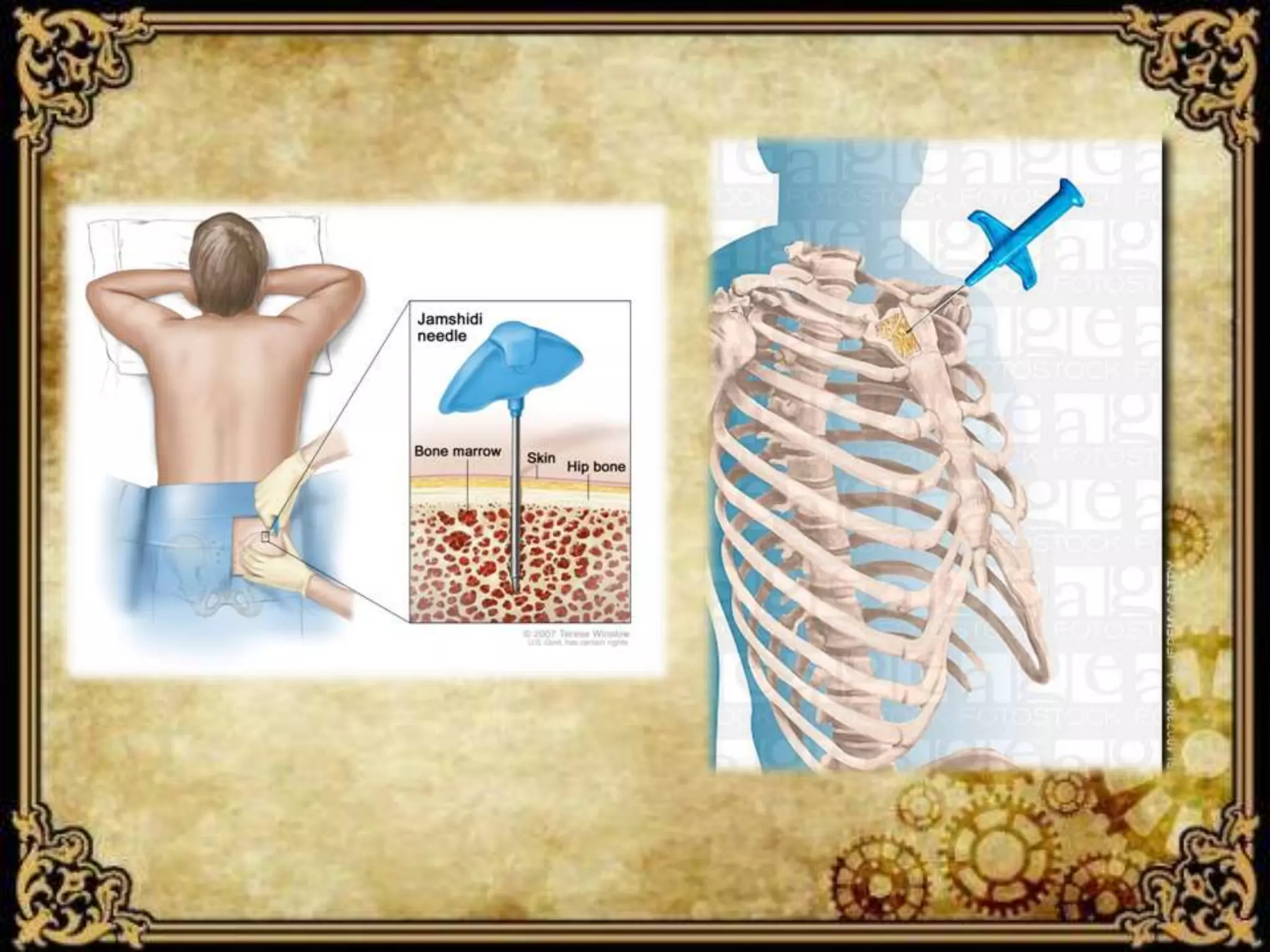 Bone marrow aspiration | PPTX