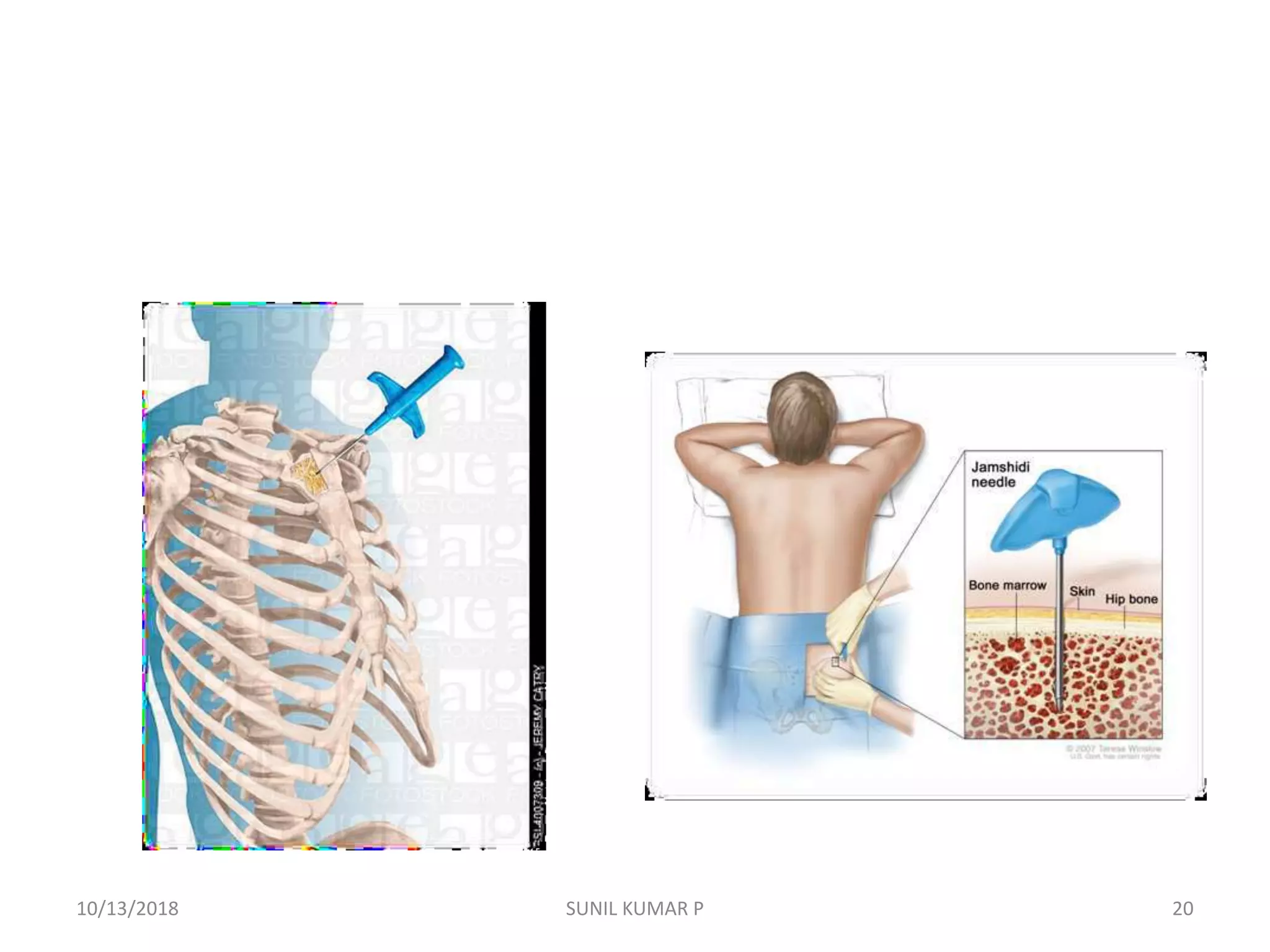 Bone Marrow Examination, BMA | PPTX