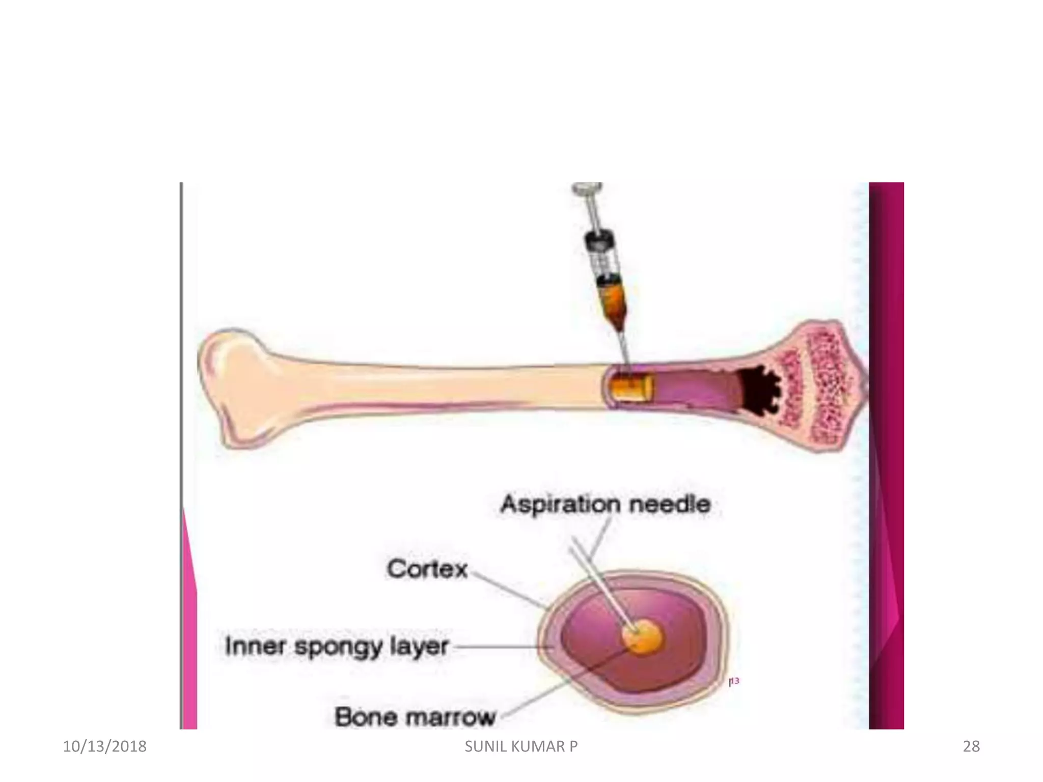 Bone Marrow Examination, BMA | PPTX