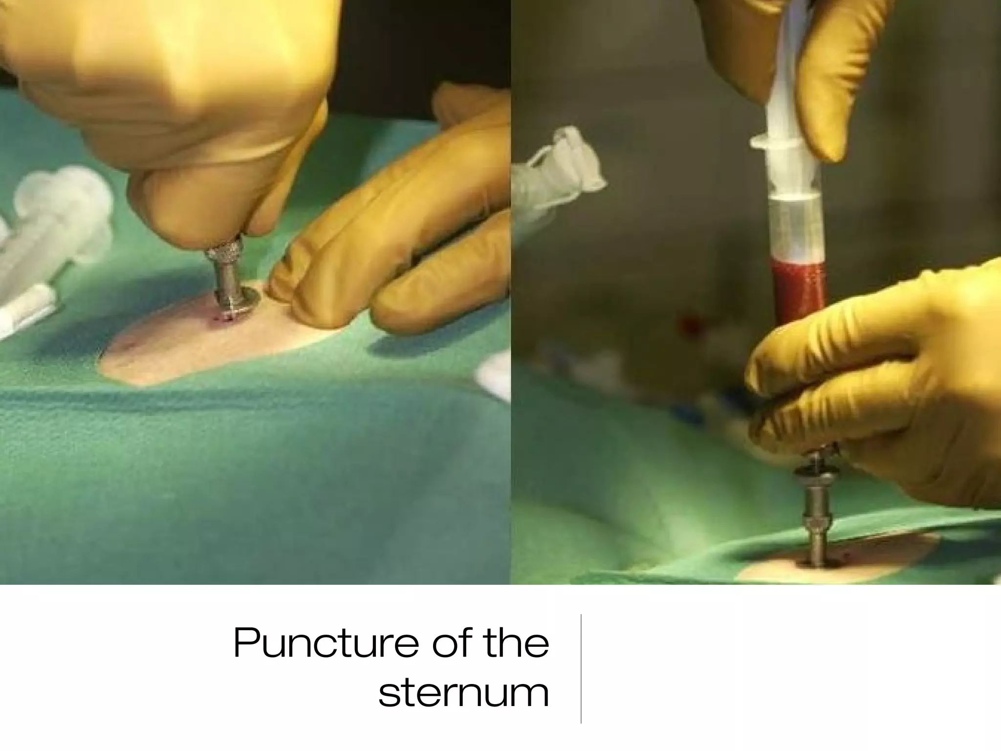 Bone marrow aspiration and biopsy | PPT