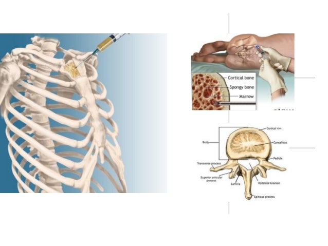 Bone marrow aspiration and biopsy