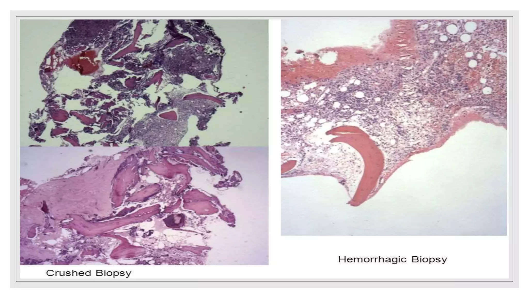 Bone marrow aspiration & biopsy | PPTX